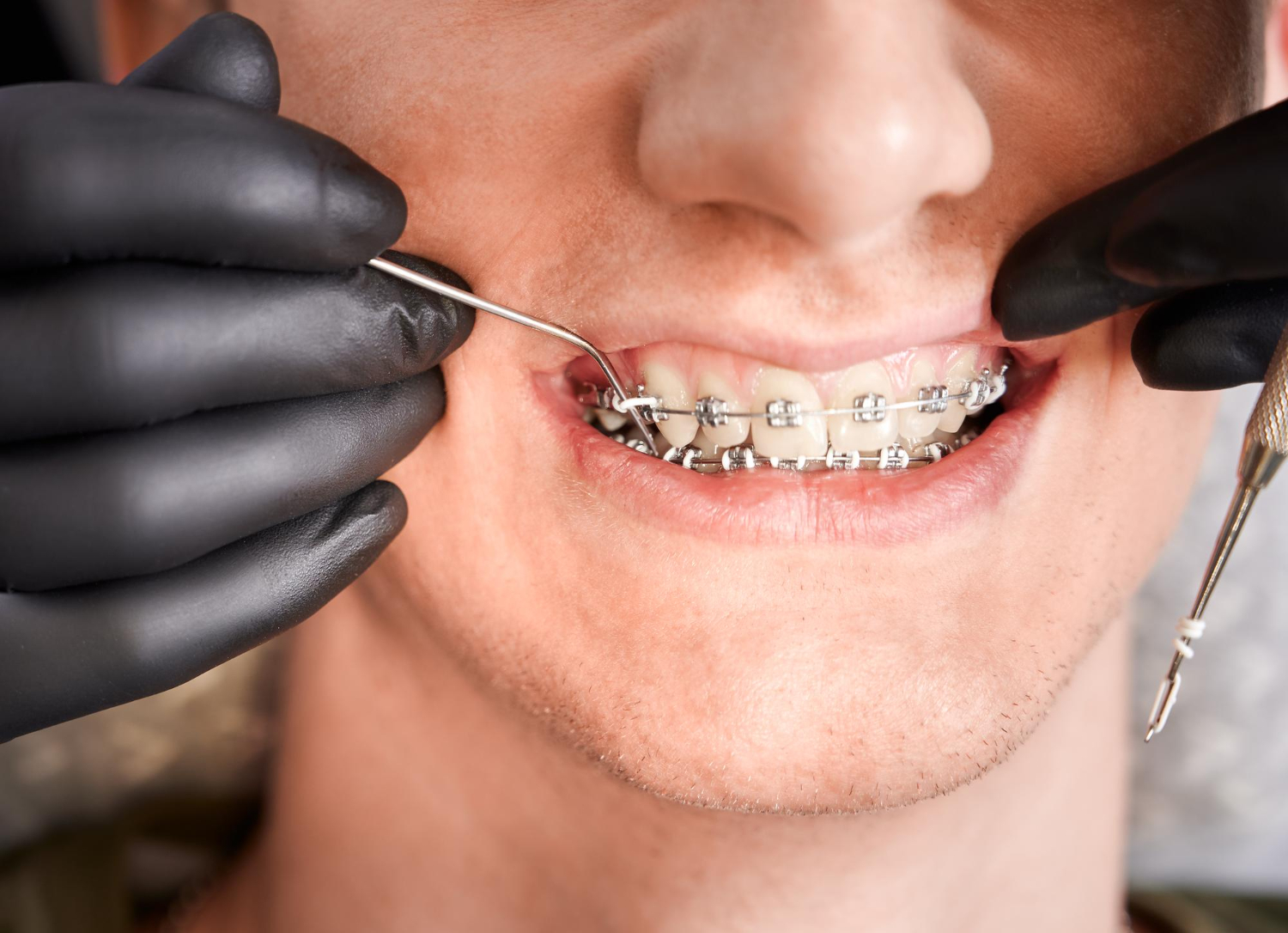 The Science Behind Braces: How They Actually Work - Halabi Orthodontics